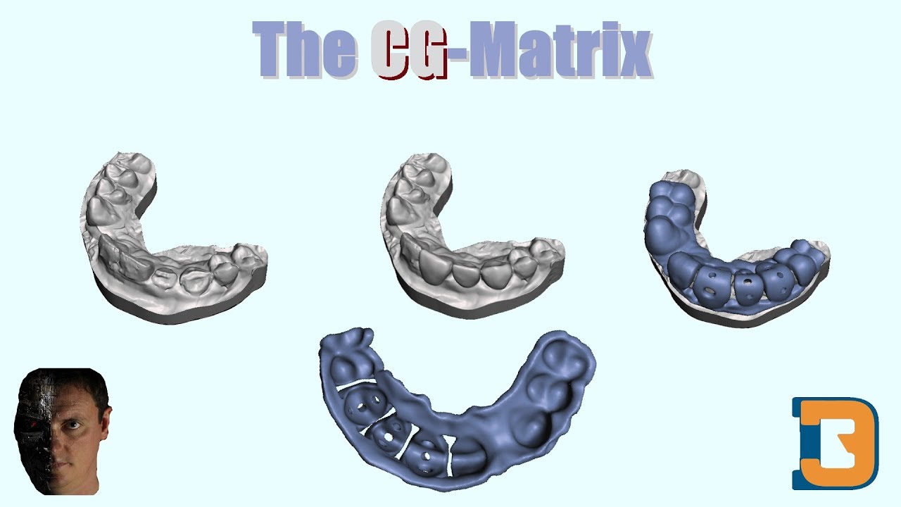 The Cory Glenn (CG)-Matrix: A Biocompatible 3D Printed Waxup Matrix ...