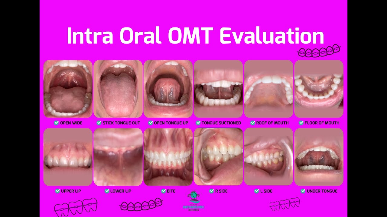 What is an Intra-Oral OMT Evaluation? - YouTube