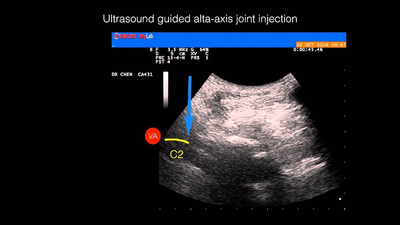 Ultrasound guided altas axis joint injection(curve probe) - YouTube