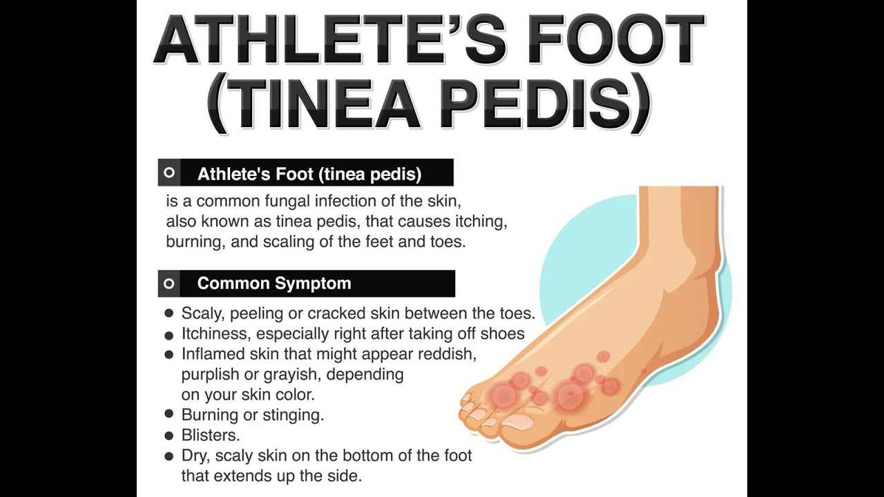 Athlete's foot or tinea pedis ; Definition, Causes, Symptoms, Diagnosis ...