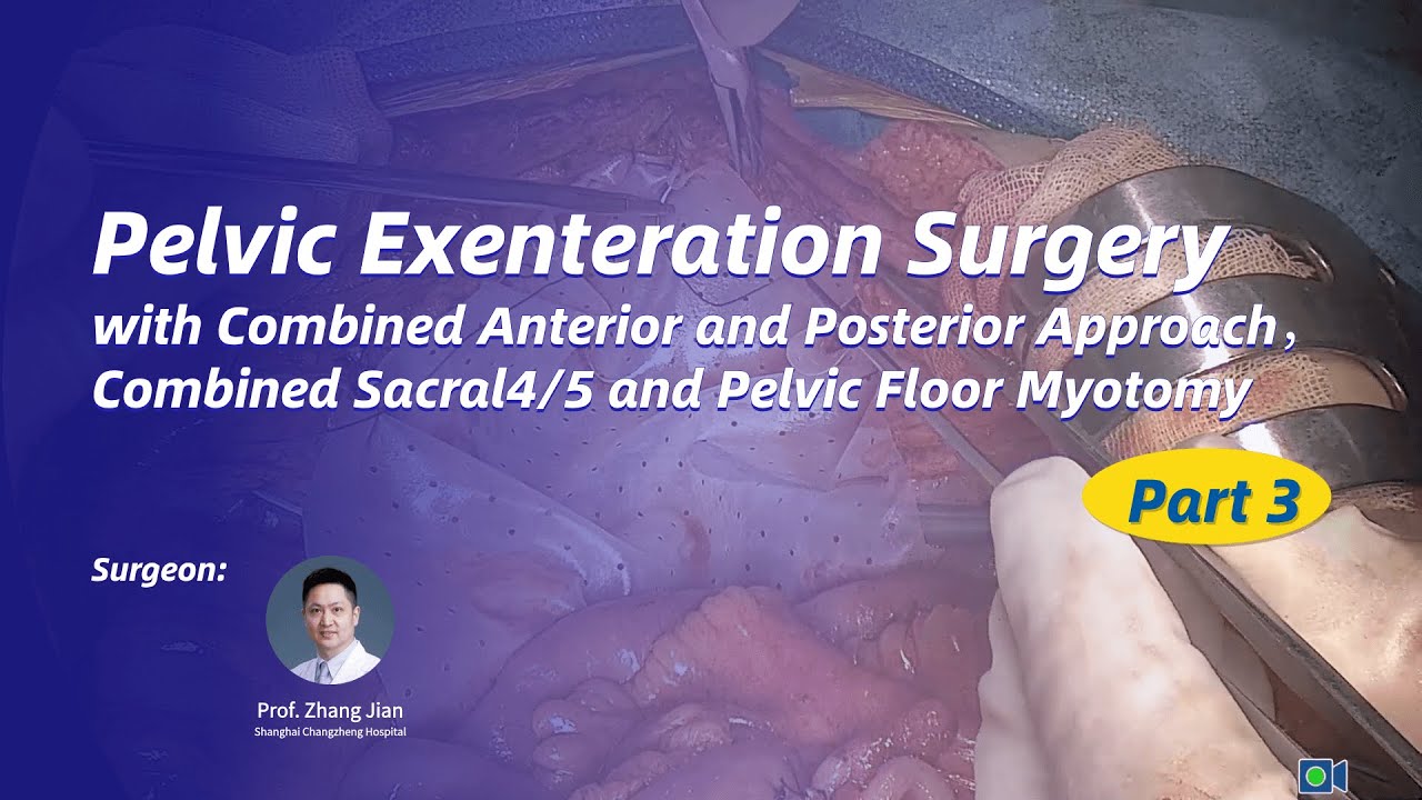 Pelvic Exenteration Surgery with Combined Anterior and Posterior ...
