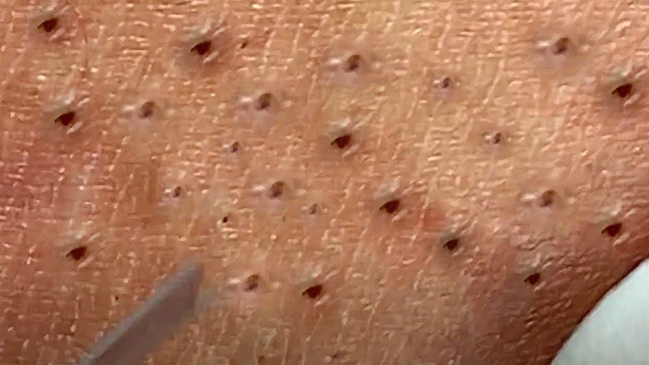 Big Cystic Acne Blackhead, Extraction Blackheads & Milia #237 ...