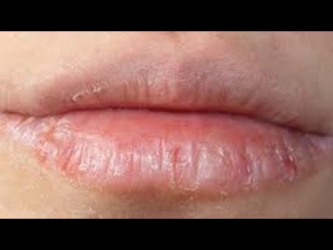 Dry Lips in winters|Amazing Gel to Smooth dry chapped lips overnight ...