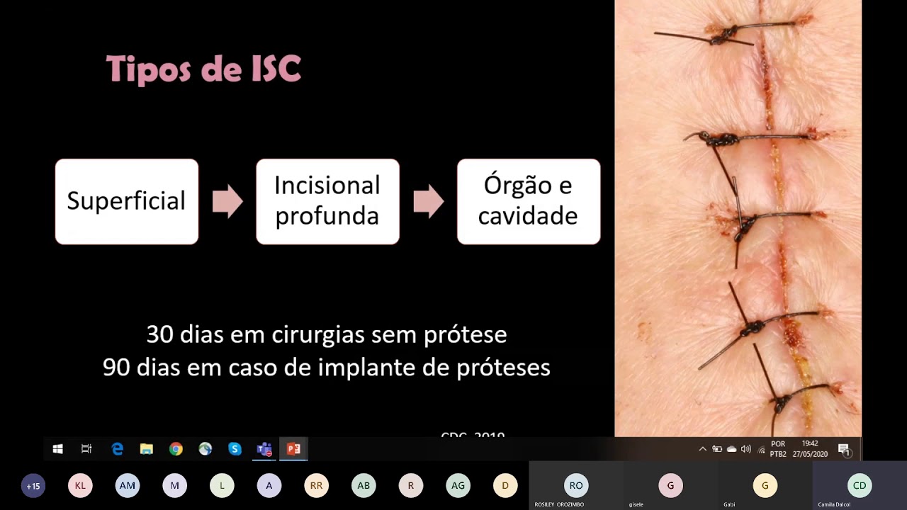 Infecção do Sítio Cirúrgico - YouTube