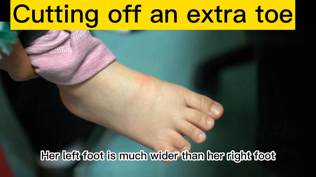 Cutting off an extra toe - YouTube