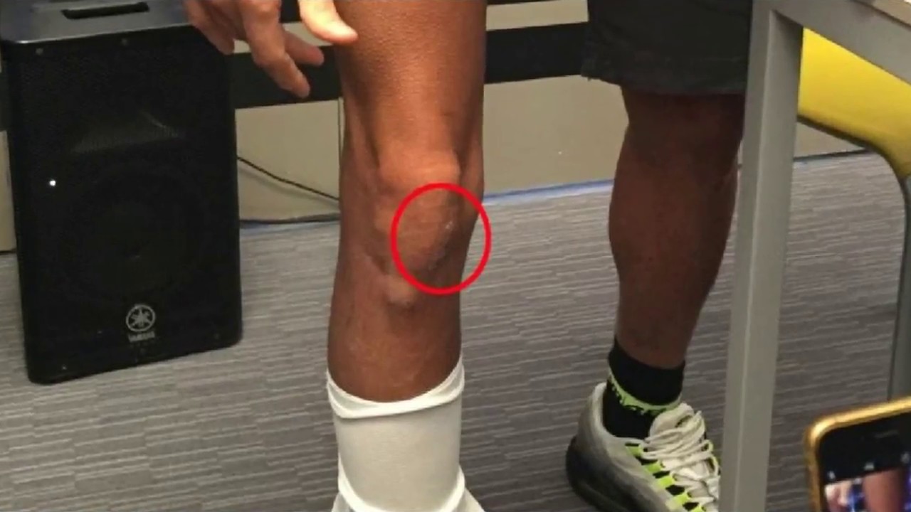 Valentino Rossi Shows His Leg at Aragon MotoGP 2017 - YouTube