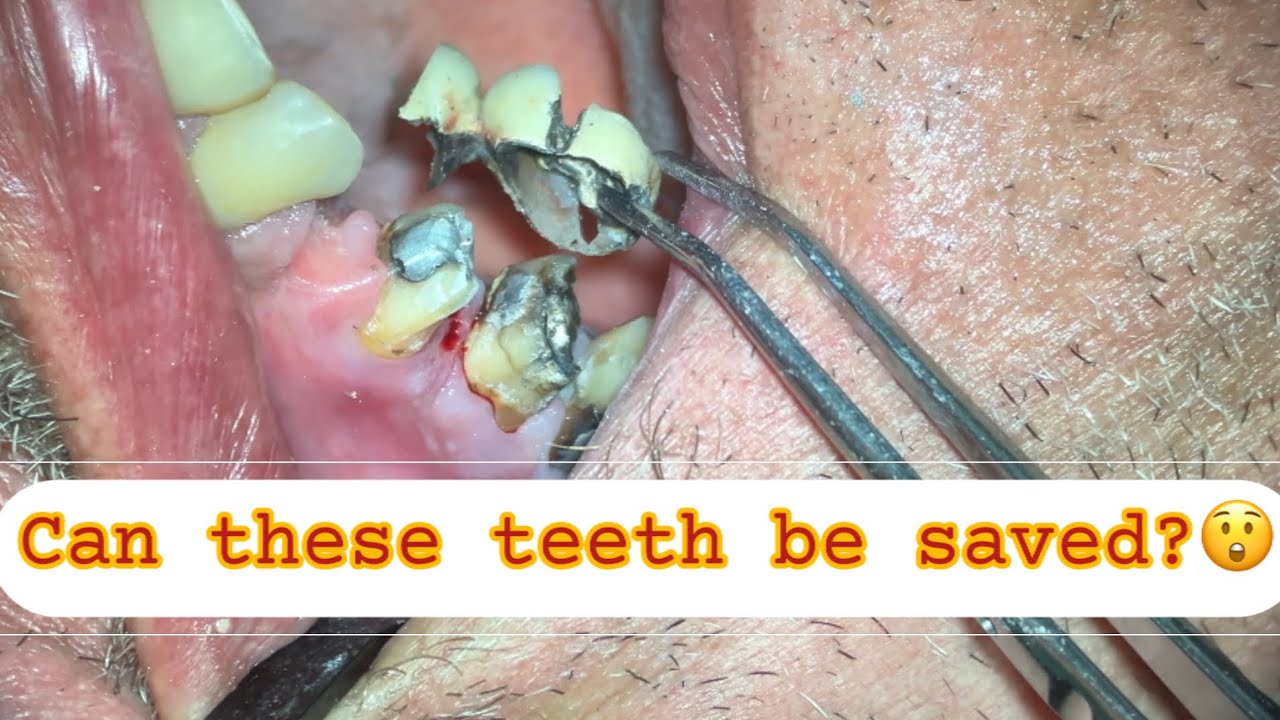 Saving decayed teeth under an old PFM bridge. Replaced by a new ...