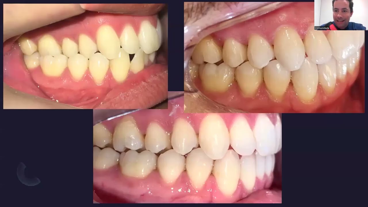 Caso clínico tratado com Invisalign. Mordida cruzada. - YouTube