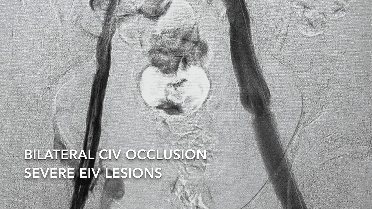 Inferior Vena Cava Total Occlusion Recanalization - YouTube