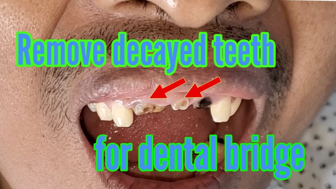 Remove decayed teeth for dental bridge ( TEETH SMILE RESTORATION ...