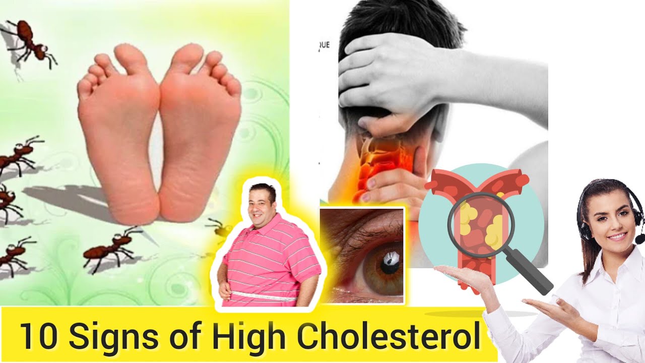 10 Signs of High Cholesterol You Shouldn't Ignore - YouTube