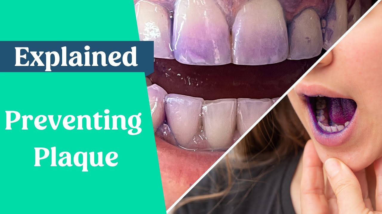How to prevent/limit plaque build up - YouTube