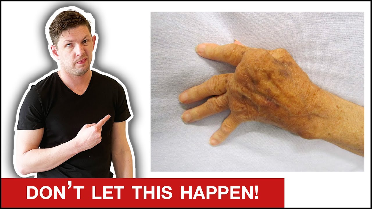 How to STOP Arthritis NOW - YouTube