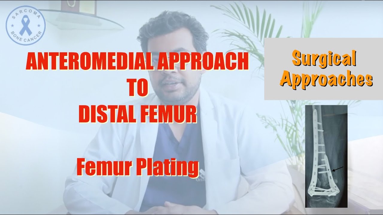 ANTEROMEDIAL APPROACH TO DISTAL FEMUR | STEP BY STEP GUIDE | DR. DEEPAK ...