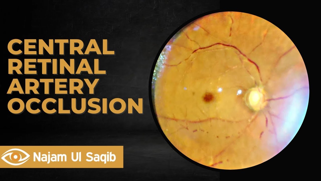 Central Retinal Artery Occlusion (Cherry Red Spot At The Macula) - YouTube