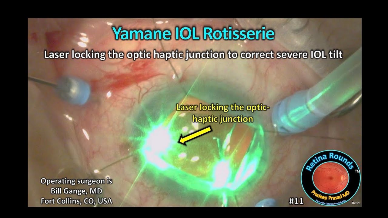 RetinaRounds™ 11: Rotisserie Phenomenon: Yamane IOL - YouTube