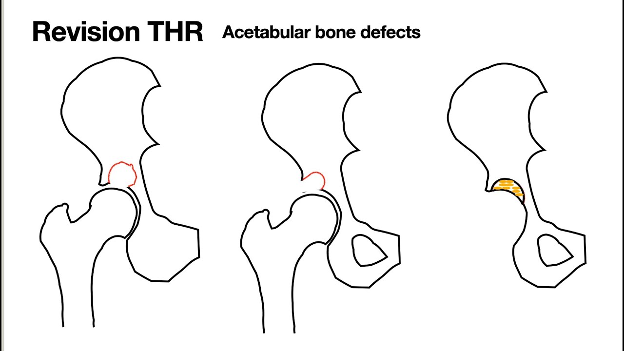 MS/DNB - Revision THR- Surgical management of bone and soft tissue ...