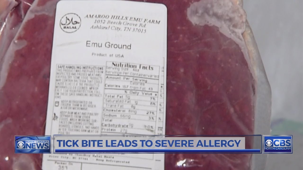UNC doctor calls Alpha-gal meat allergy 'tremendously underdiagnosed ...