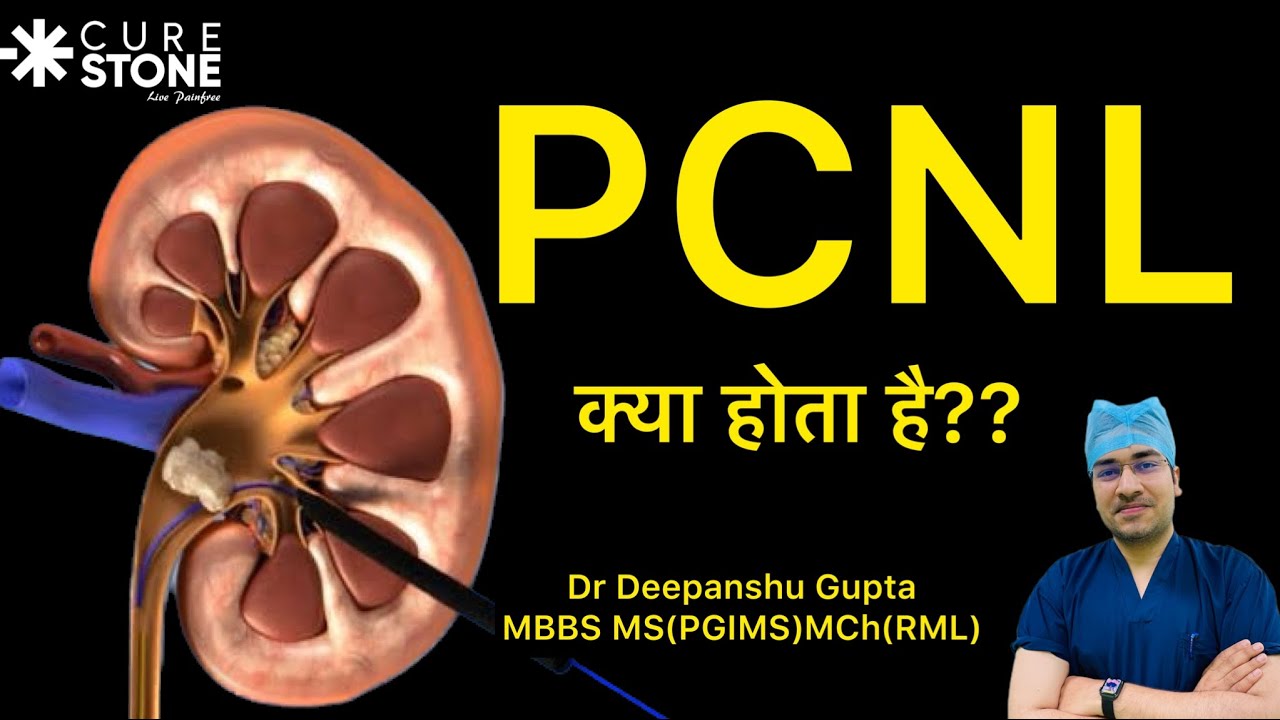 Kidney Stone PCNL | PCNL क्या होता है?| Kidney Stone Treatment ...