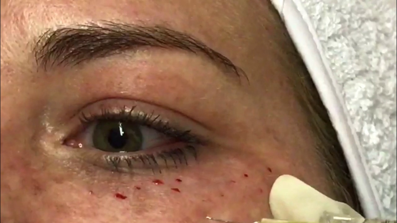 Redermalization with Hylual and Skin Renewal - YouTube