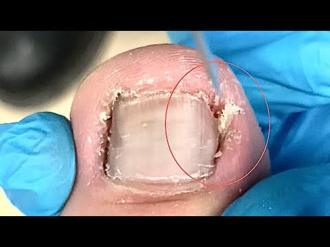 The sharp point at the front of the toenail, which is very deep【Xiao ...