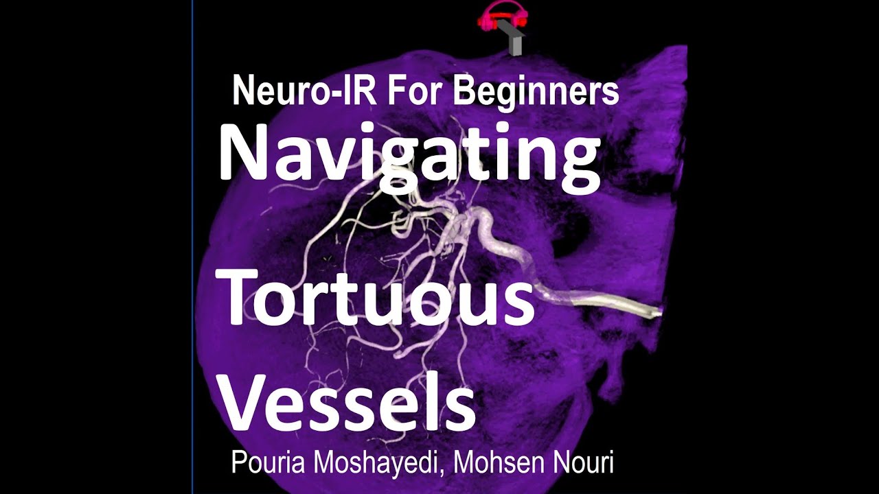 How to Navigate Tortuous Vessels in Neuro-Endovascular Procedures - YouTube