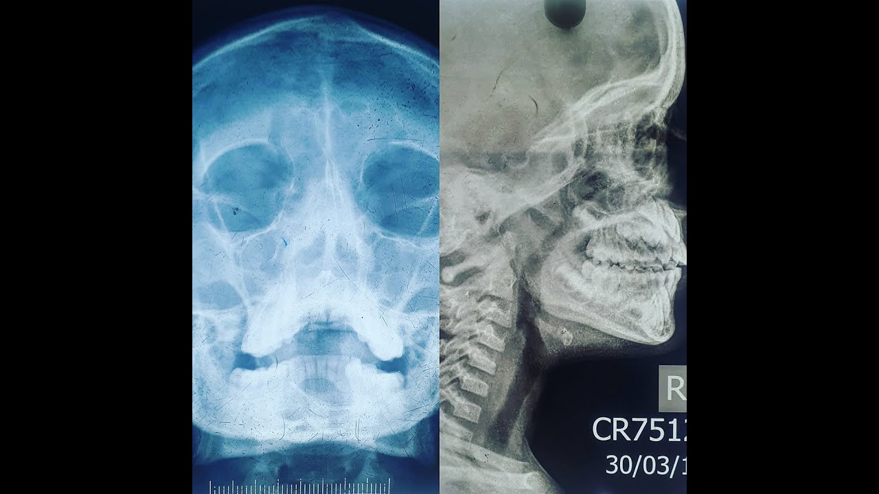 X-RAYS IN E.N.T made easy for 3rd MINOR MBBS & PG RESIDENTS from EXAM ...