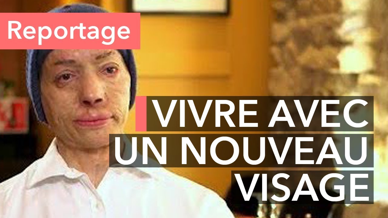 Défiguré : il tente d'appréhender son nouveau visage - Ça commence ...