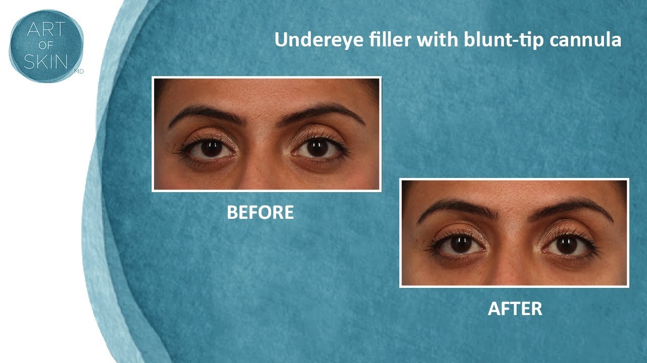 Tear trough undereye hollow filler with blunt tip cannula - YouTube