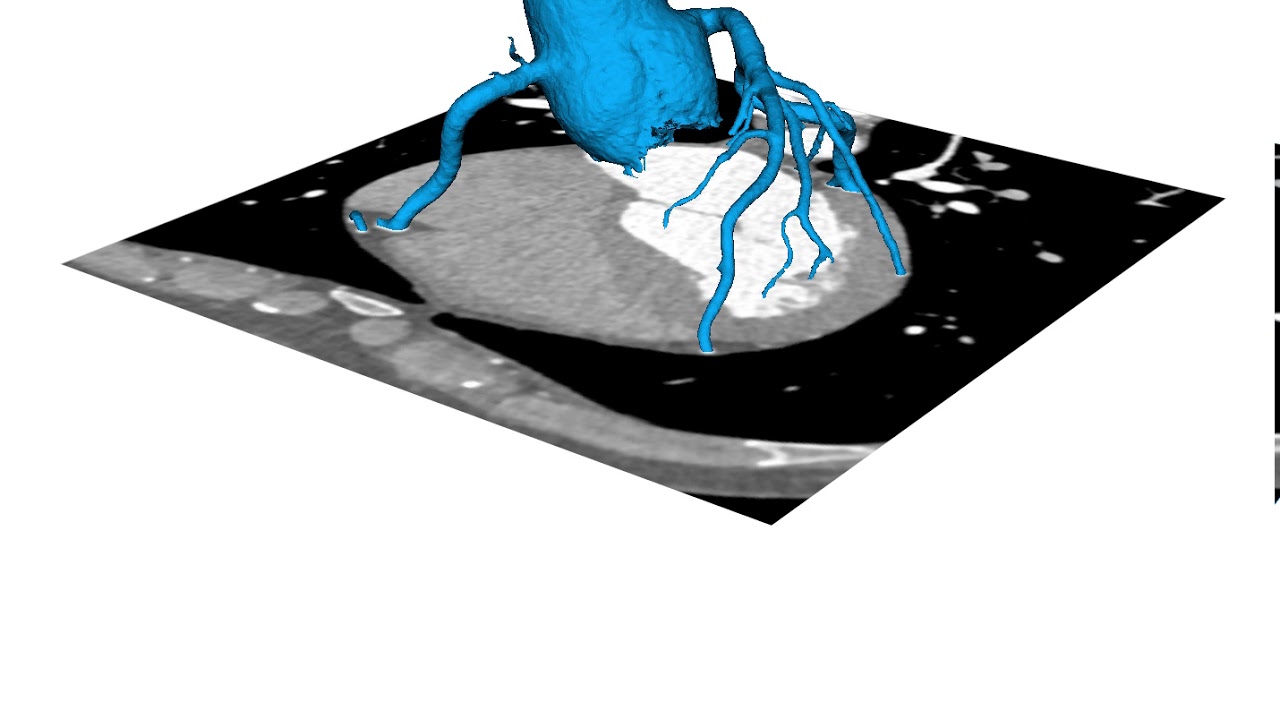 CT Image segmentation and 3D reconstruction - YouTube