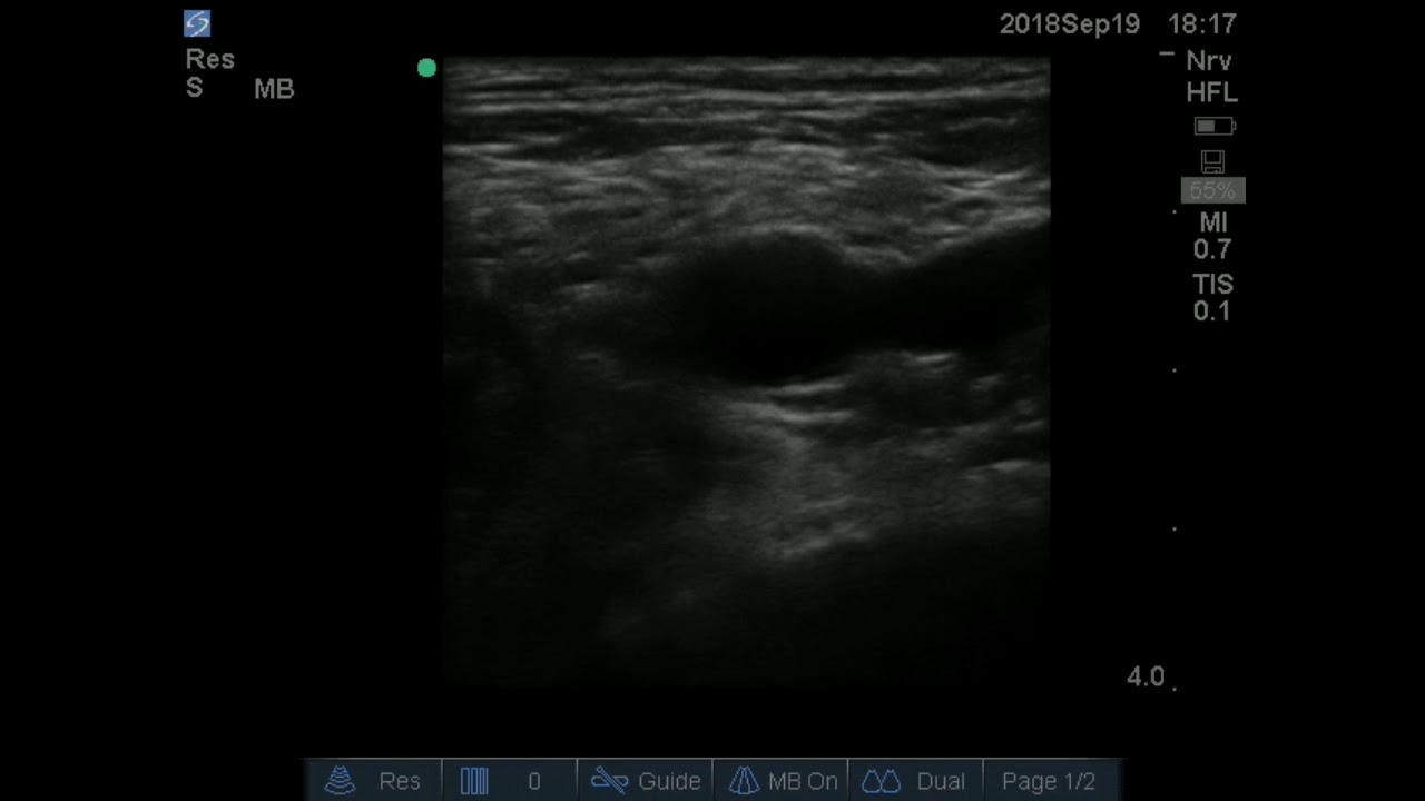 Ultrasound guided Obturator Nerve Block - YouTube