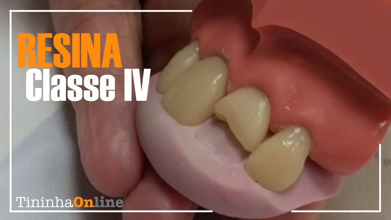 Resina Classe IV - YouTube