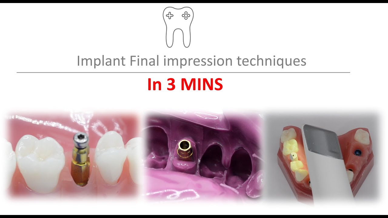 Implant impression techniques in 3 mins - closed tray - open tray -scan ...