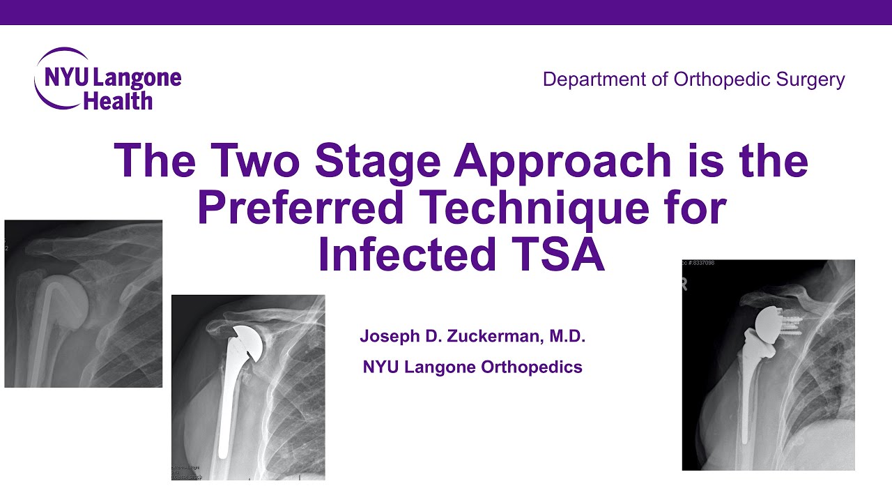 The Two Stage Approach is the Preferred Technique for Infected TSA ...
