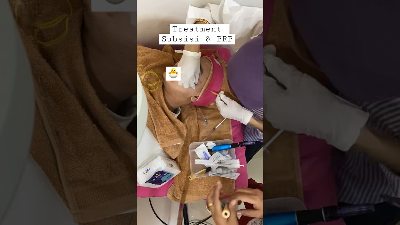 Bopeng memudar dengan treatment subsisi+prp #prp #subsisi #kecantikan # ...