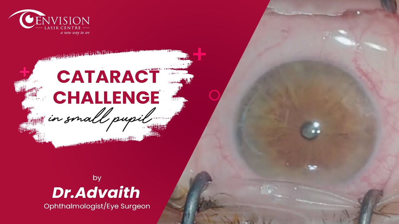 Cataract Challenge in small pupil 👁 | Best Eye Surgery Specialist in ...