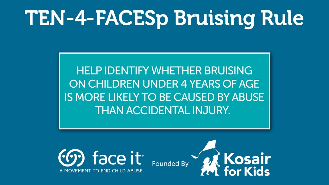 TEN-4-FACESp Bruising Rule (Animated) - YouTube