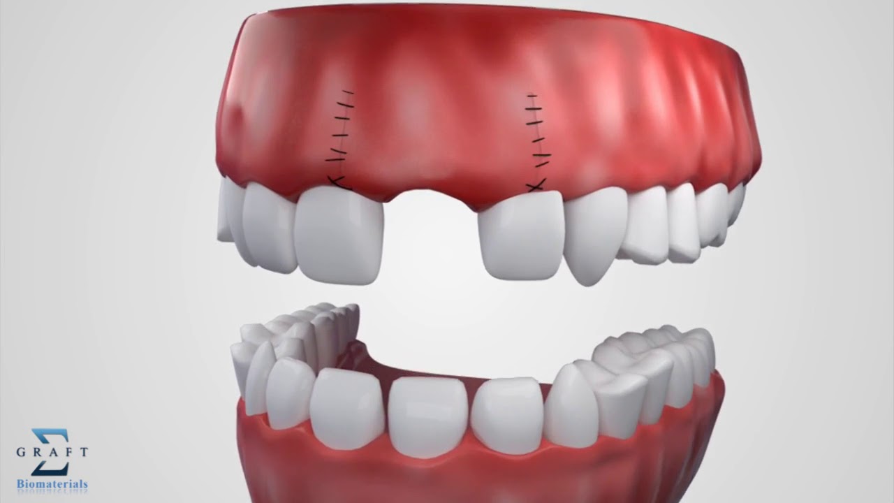 SigmaGraft Inc Biomaterials - YouTube