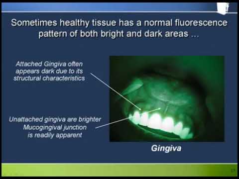 Fluorescence Visualization in the Normal Oral Cavity - YouTube