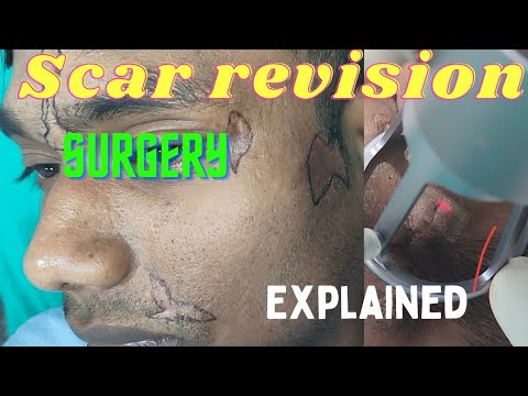 Scar revision surgery - Steps explained| How we perform scar revision ...