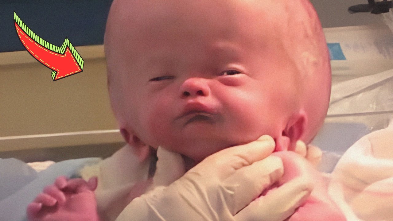 Baby was born with a HUGE HEAD, so their parents decided... - YouTube