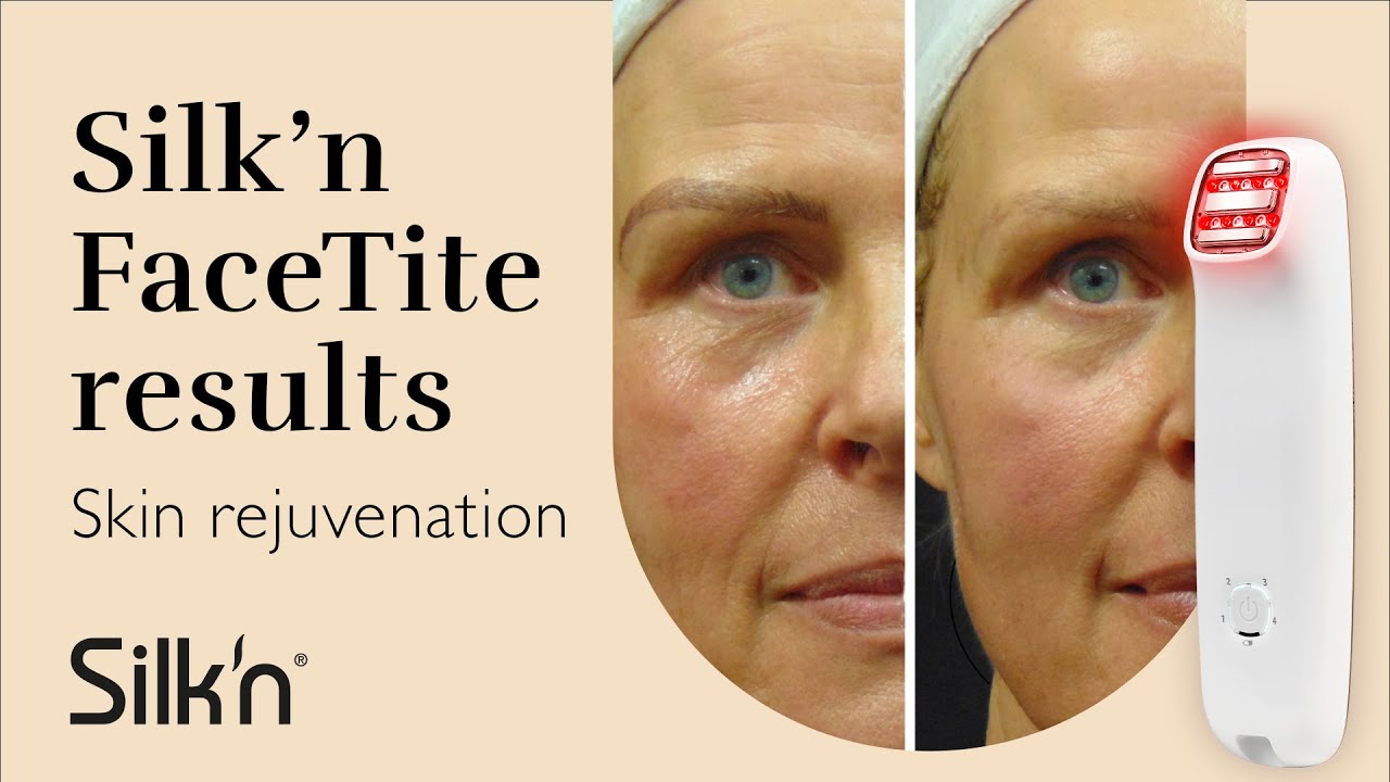 Silk'n FaceTite - Skin rejuvenation - Before and After - YouTube