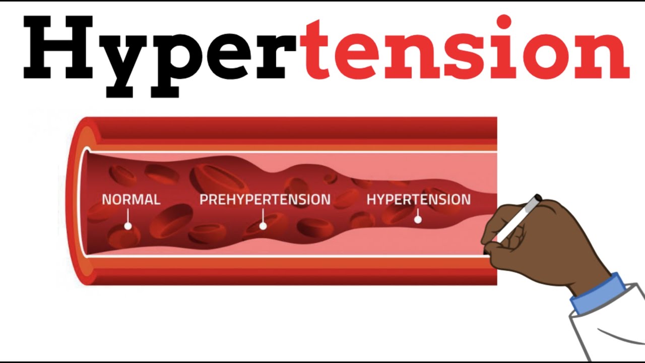 Hypertension - Best for beginners (Risk factors, Pathophysiology ...