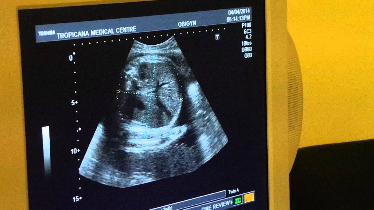 34 Weeks Pregnancy Ultrasound YouTube