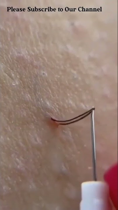 Ingrown Hair👍 Ingrownhair Ingrownhairremoval Ingrownhairs 👶💁 Shorts Viral Tiktok Youtube