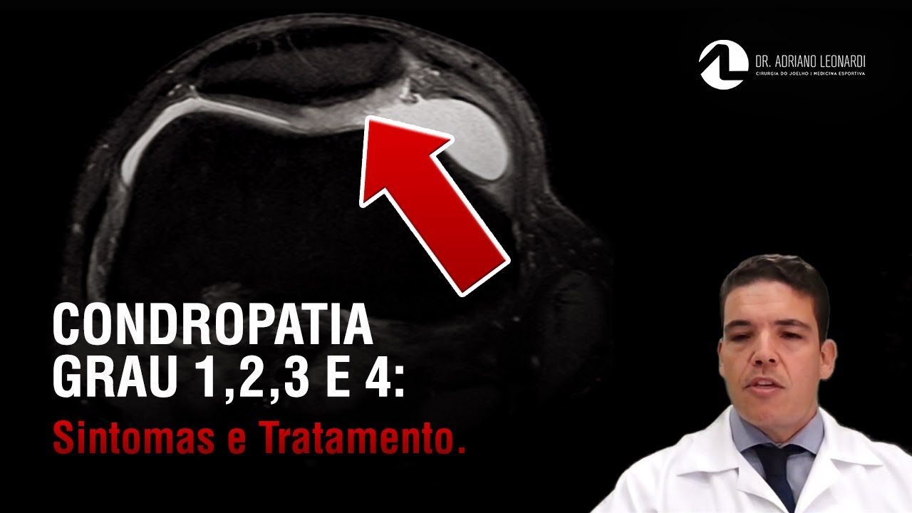 Condropatia grau 1, 2, 3 e 4: sintomas e tratamento - YouTube