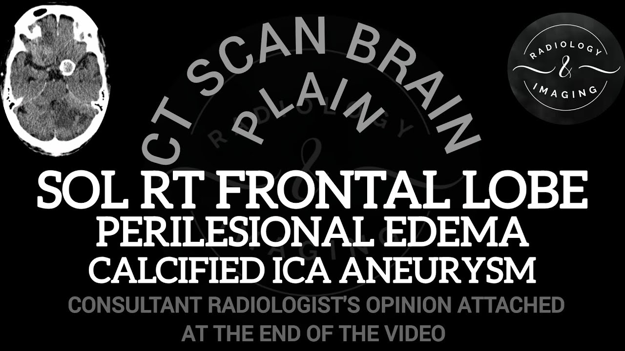 CT Scan Brain Plain to rule SOL or any other Pathology in the Brain ...