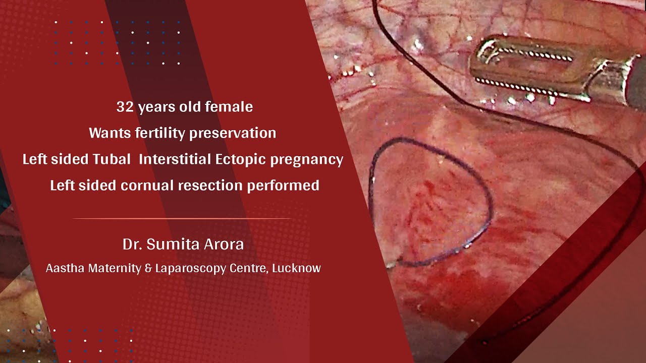 Interstitial Tubal Ectopic Pregnancy - Laparoscopic cornual resection ...