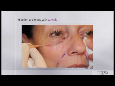 Teosyal Redensity 2 injection by Pr Trevidic EN - YouTube