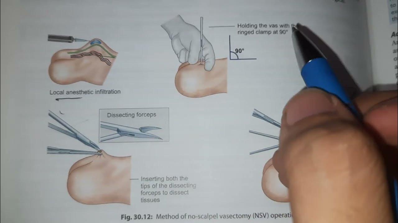 Contraception 9 Permanent Methods Vasectomy And Tubectomy Youtube